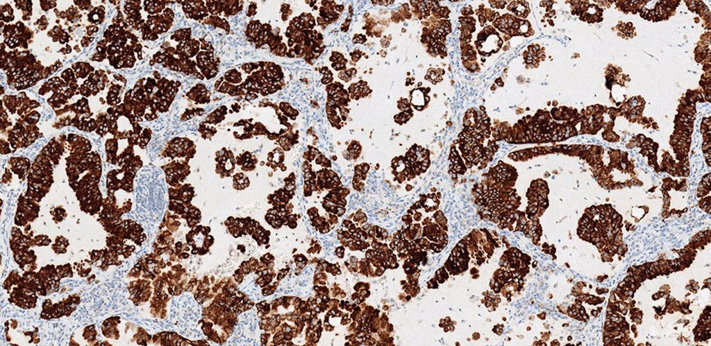 Roche recibe la aprobación de la FDA para la prueba VENTANA ALK (D5F3 ...