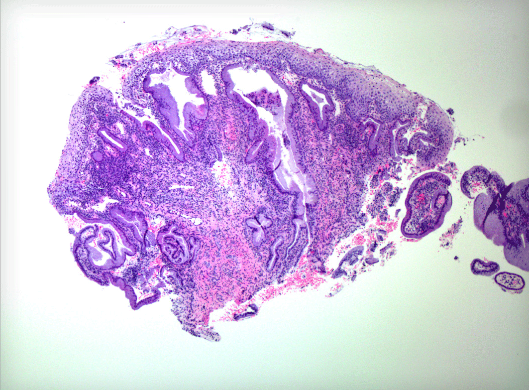 CINtec® Histology（p16） | ロシュ・ダイアグノスティックス