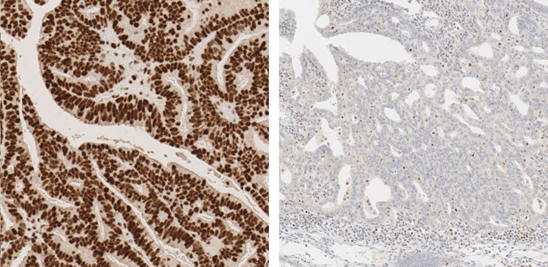 VENTANA MMR RxDx Panel (US FDA Approved)