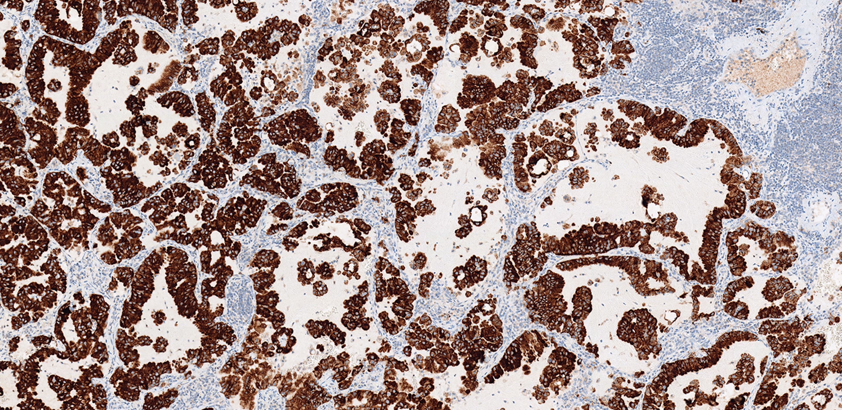 Lung cancer IHC portfolio