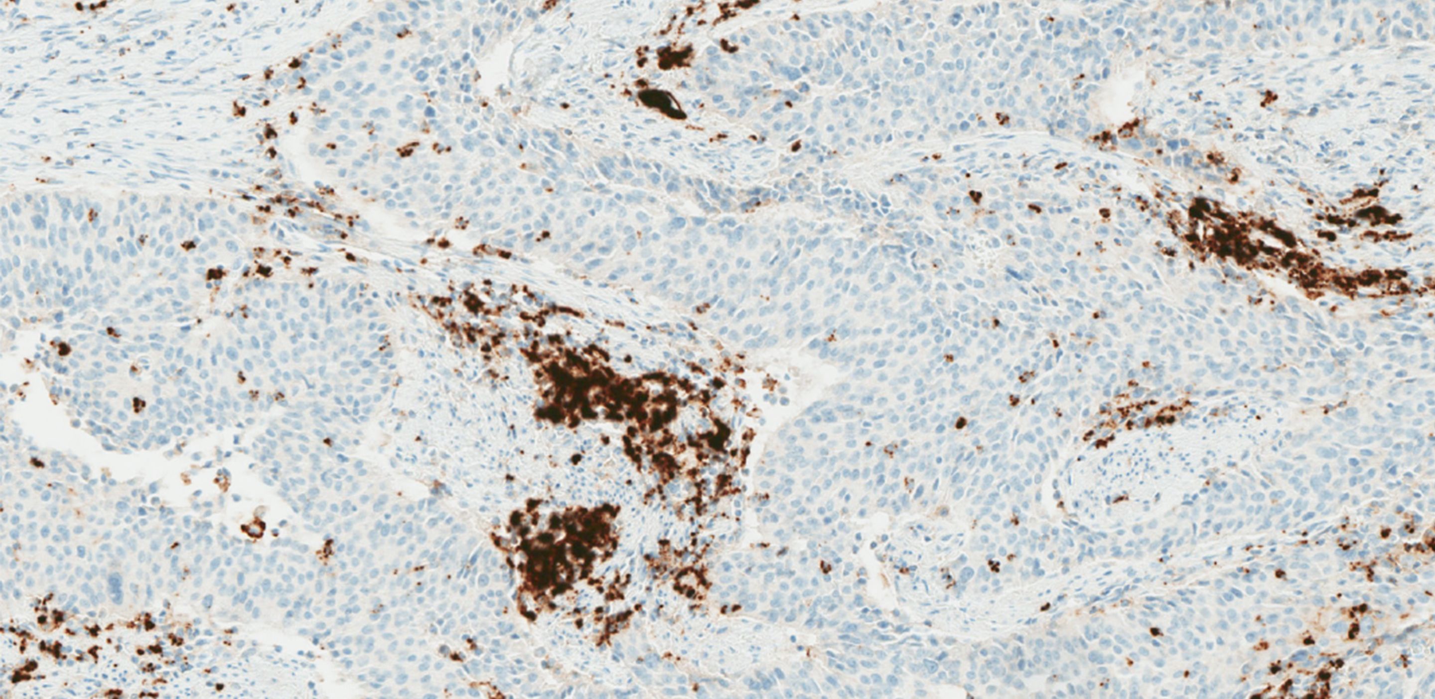 VENTANA PD-L1 (SP142) Assay