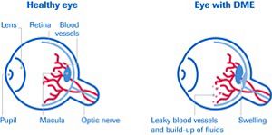 ¿Qué es el edema relacionado con la diabetes (DME)? | Guía de salud ...